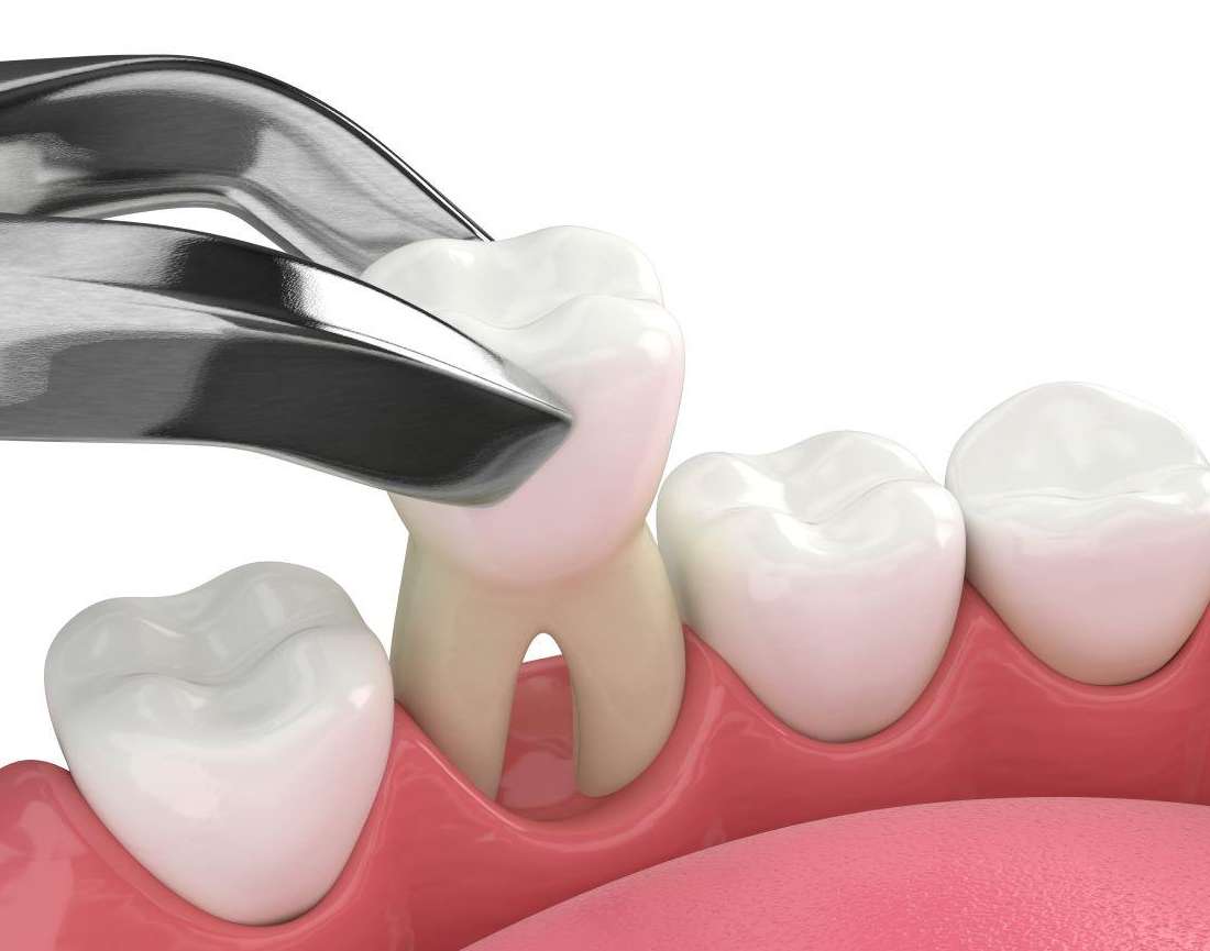Tooth Extractions: Procedure, Aftercare, and Recovery | General ...